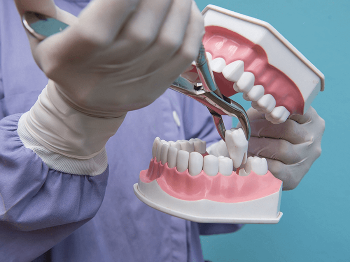 Tooth Extractions - Family Dental Care